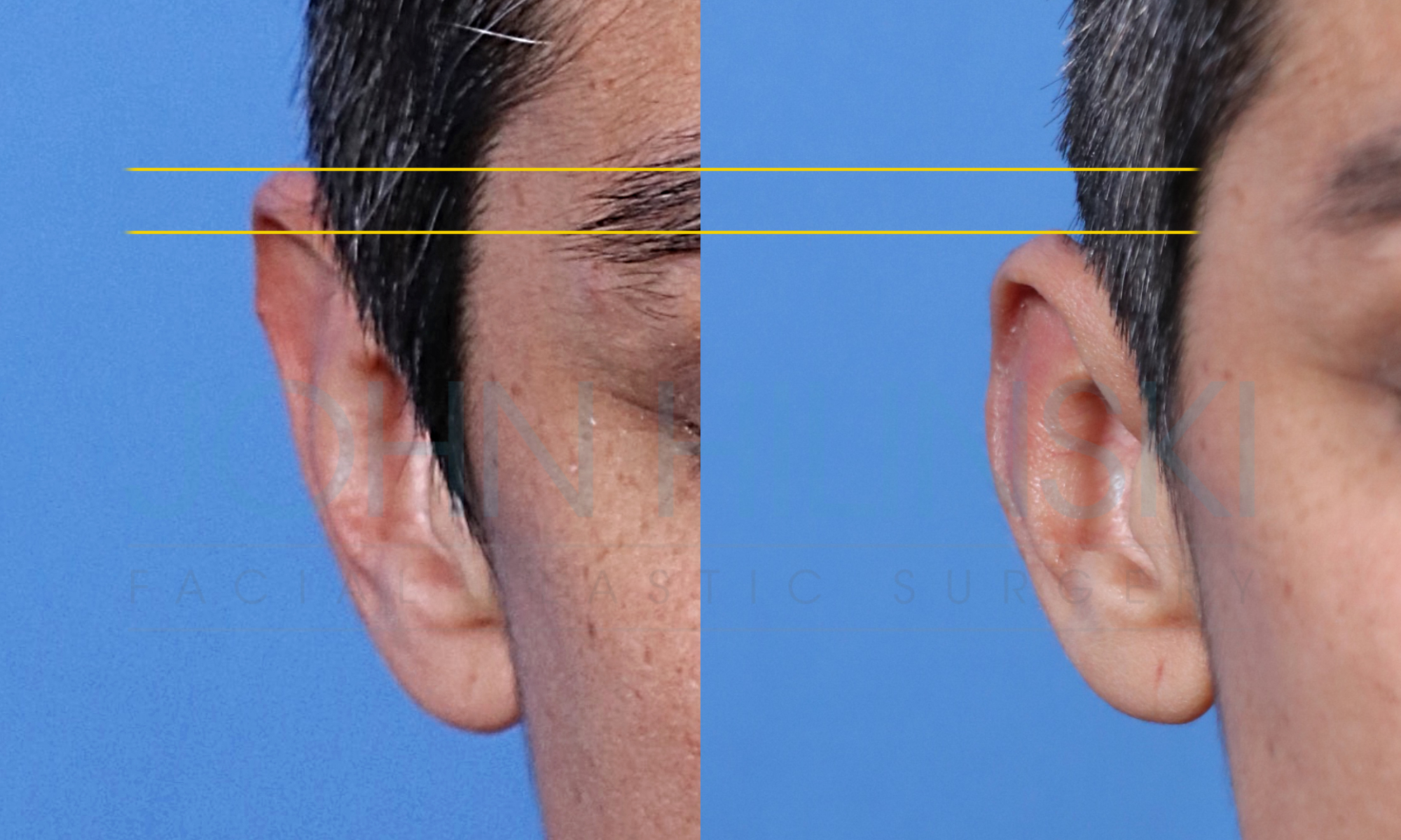 How Macrotia Surgery Changes the Front View of the Ear | Dr. John Hilinski